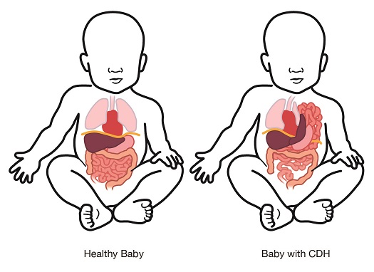 Congenital Diaphragmatic Hernia Ultrasound